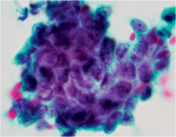Basal Cells In Pap Smear
