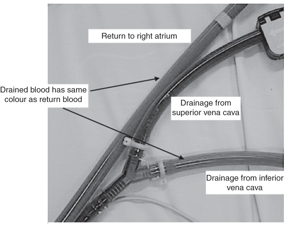 Monitoring the patient on ECMO (Chapter 4) - ECMO in the Adult Patient