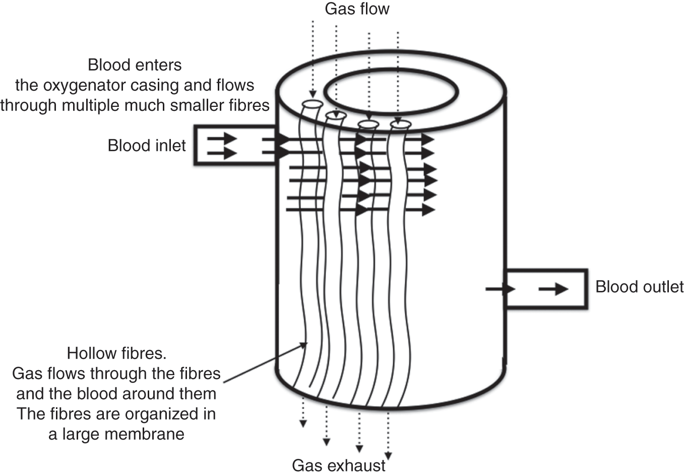 The ECMO circuit (Chapter 3) - ECMO in the Adult Patient