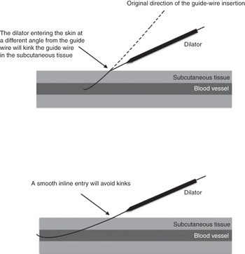 Cannulation and decannulation (Chapter 6) - ECMO in the Adult Patient
