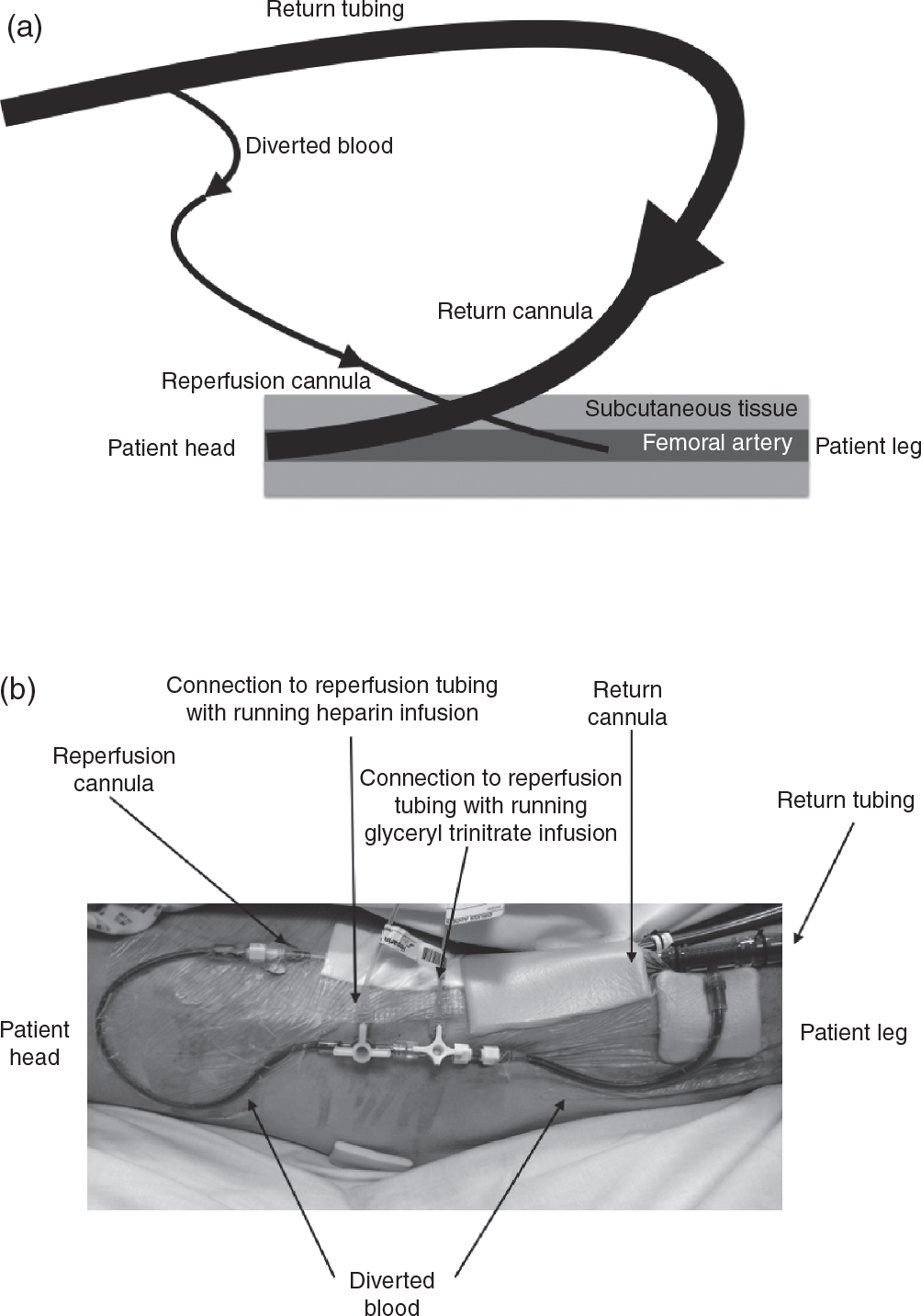 Cannulation and decannulation (Chapter 6) - ECMO in the Adult Patient