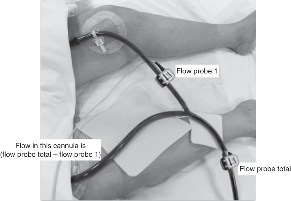 The ECMO circuit (Chapter 3) - ECMO in the Adult Patient