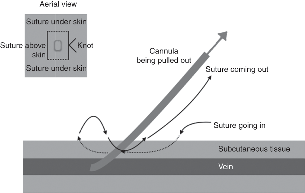 Cannulation and decannulation (Chapter 6) - ECMO in the Adult Patient