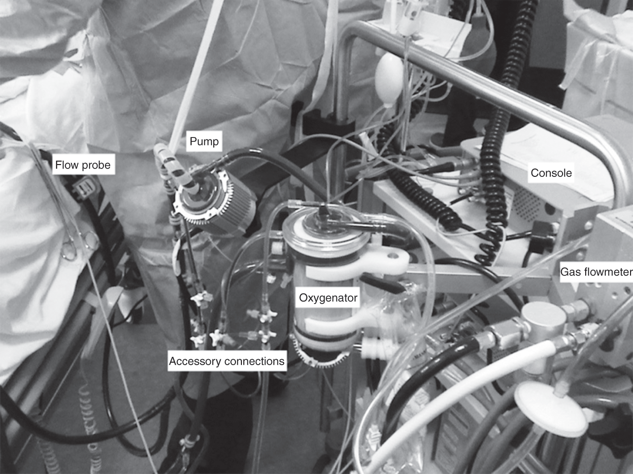 The ECMO circuit (Chapter 3) - ECMO in the Adult Patient