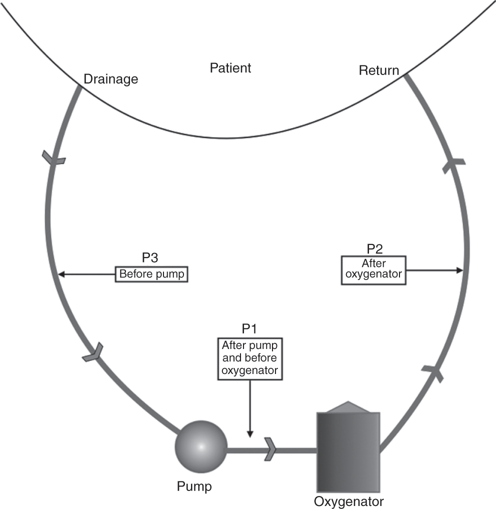 The ECMO circuit (Chapter 3) - ECMO in the Adult Patient