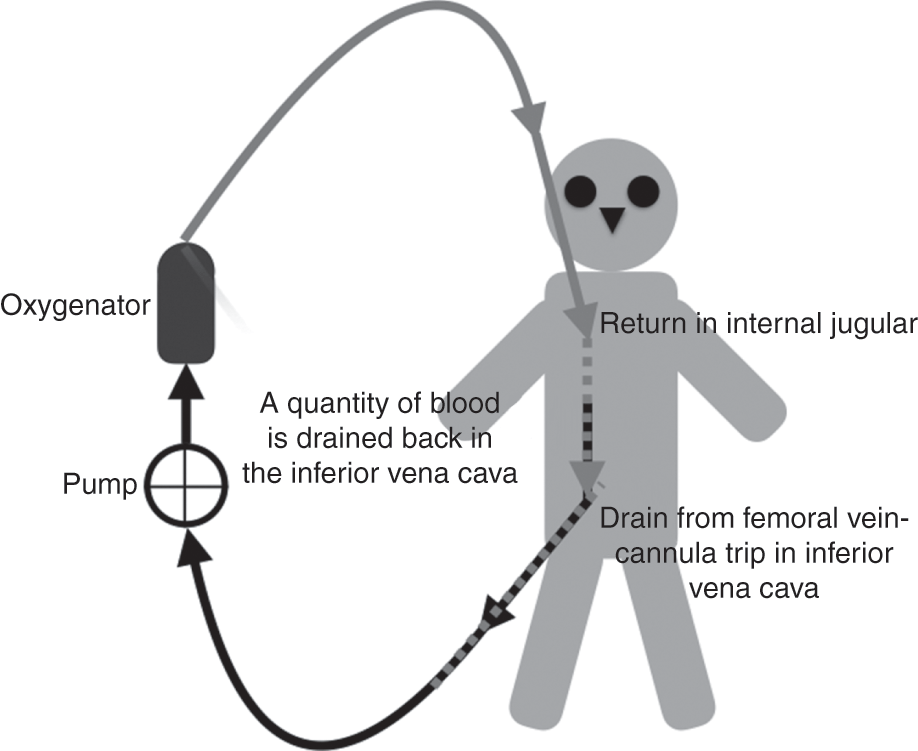 Monitoring the patient on ECMO (Chapter 4) - ECMO in the Adult Patient
