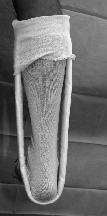 Reverse Sugar Tong Splint