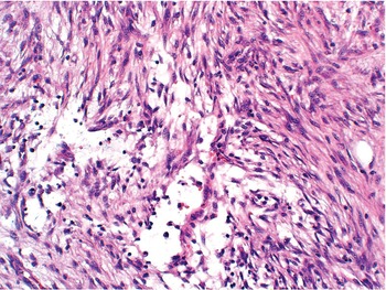 Fibrous Papule Histology