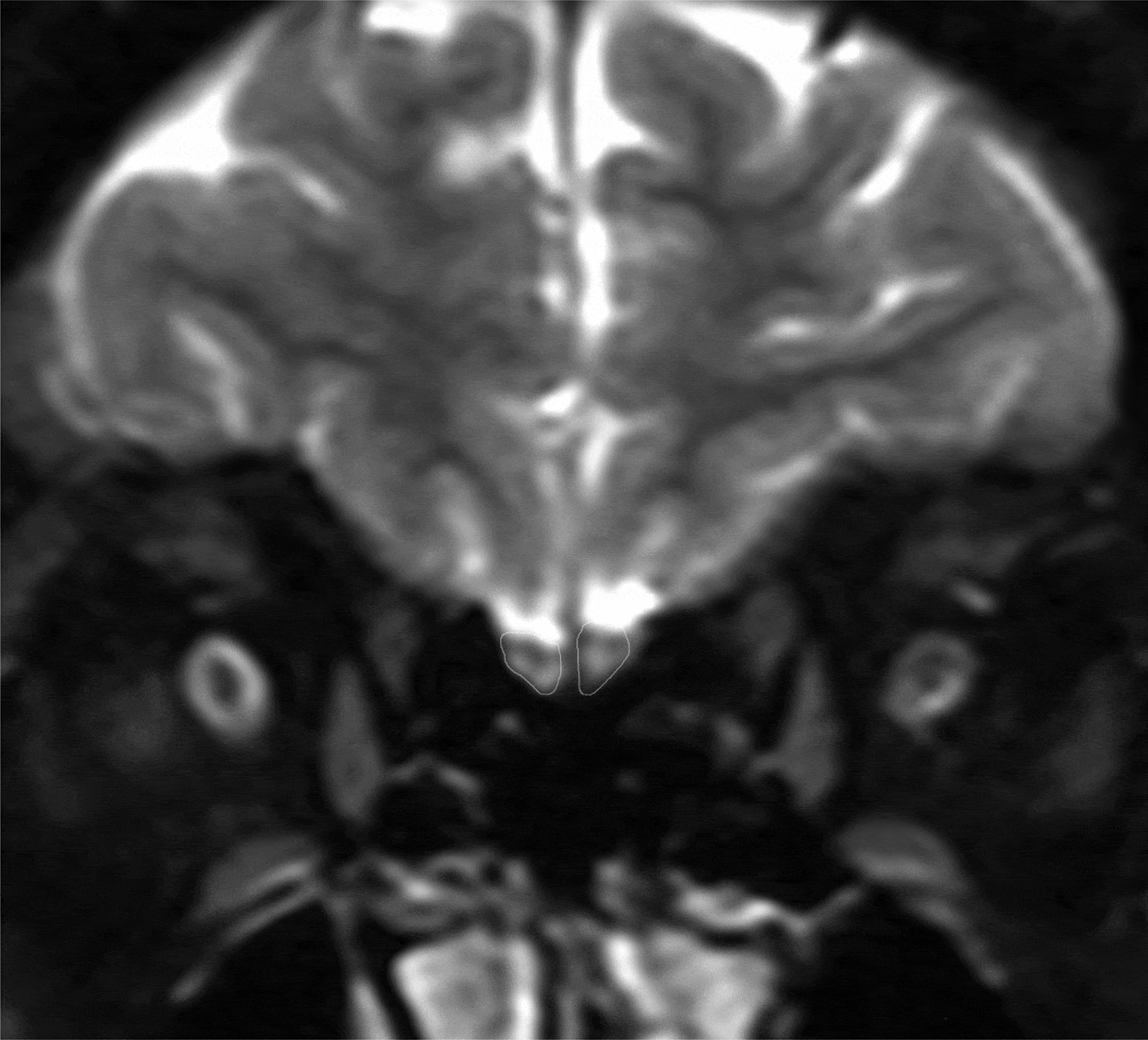 Olfactory bulb volume and olfactory sulcus depth in patients with ...