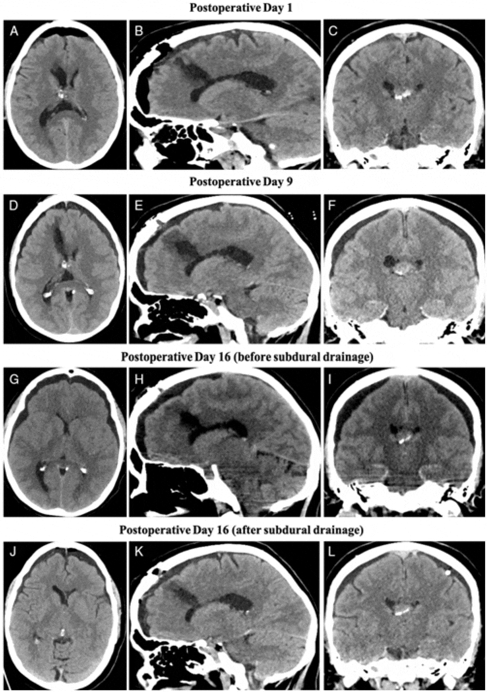 Uncal Herniation Due to External Hydrocephalus Post Intraventricular ...