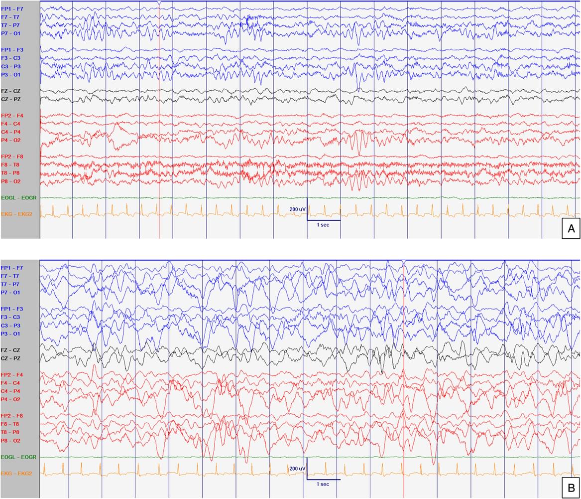 Reflex Seizures in a Patient with CDKL5 Deficiency Disorder | Canadian ...