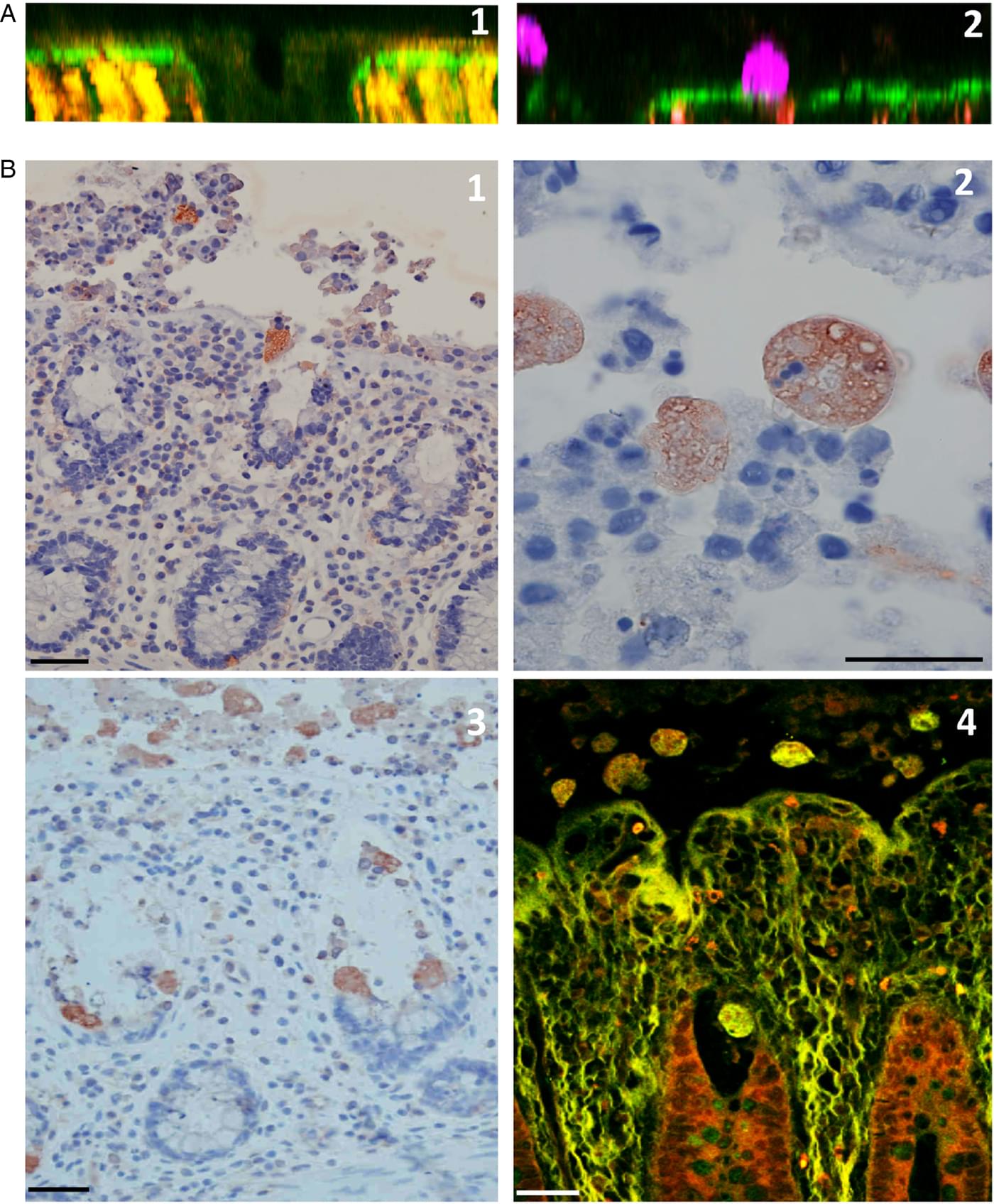 Crosstalk between Entamoeba histolytica and the human intestinal tract ...