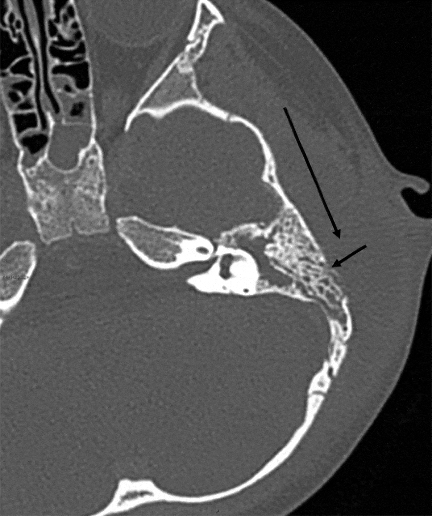 Radiology of acute mastoiditis and its complications: a pictorial ...