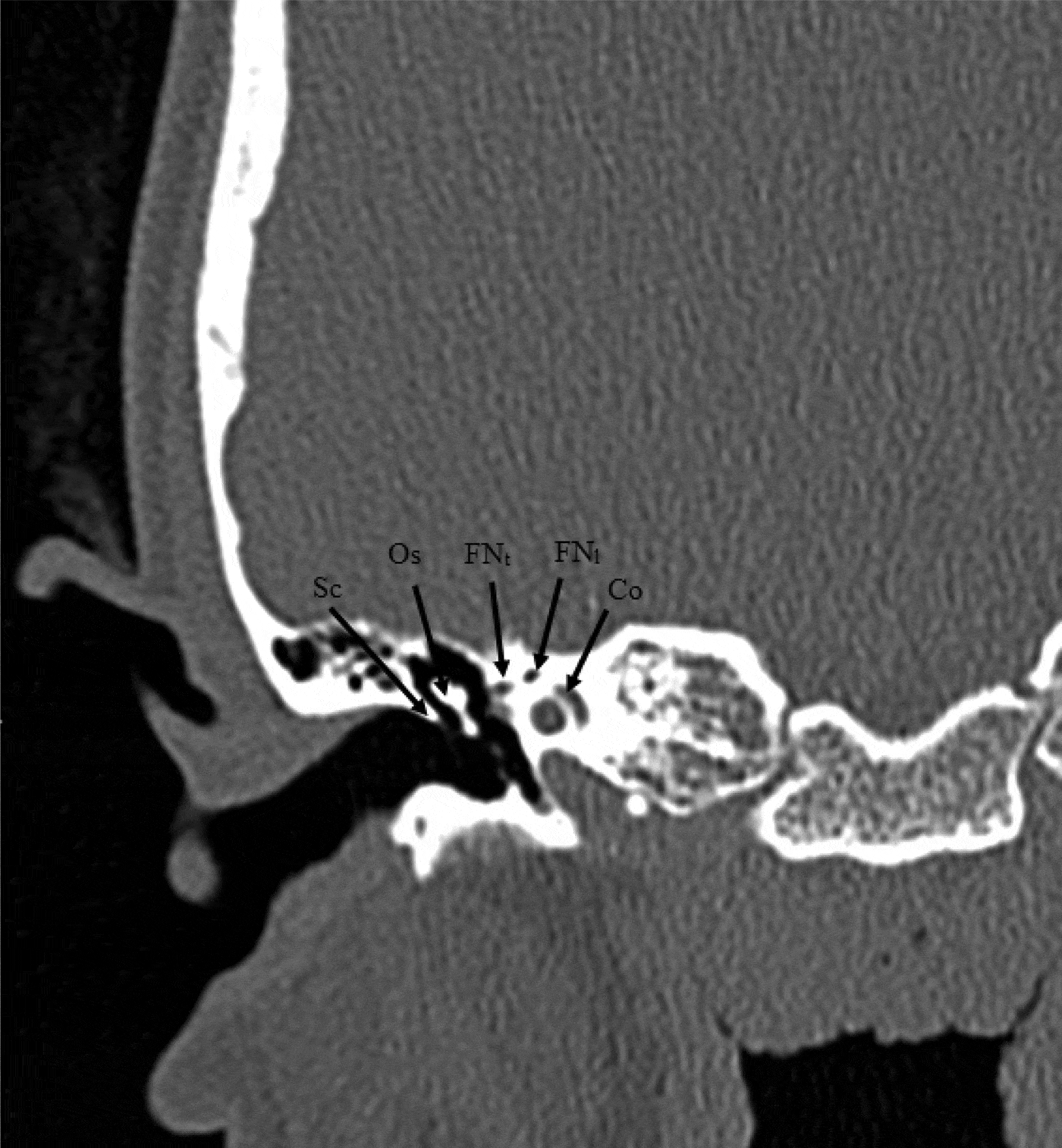 Radiology of acute mastoiditis and its complications: a pictorial ...