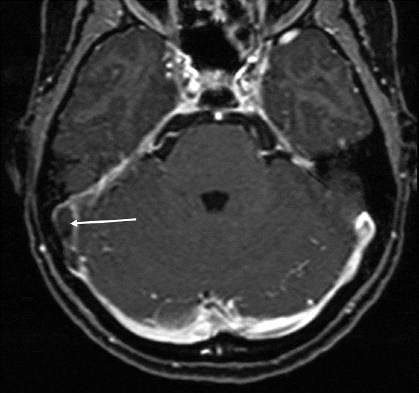 Radiology of acute mastoiditis and its complications: a pictorial ...