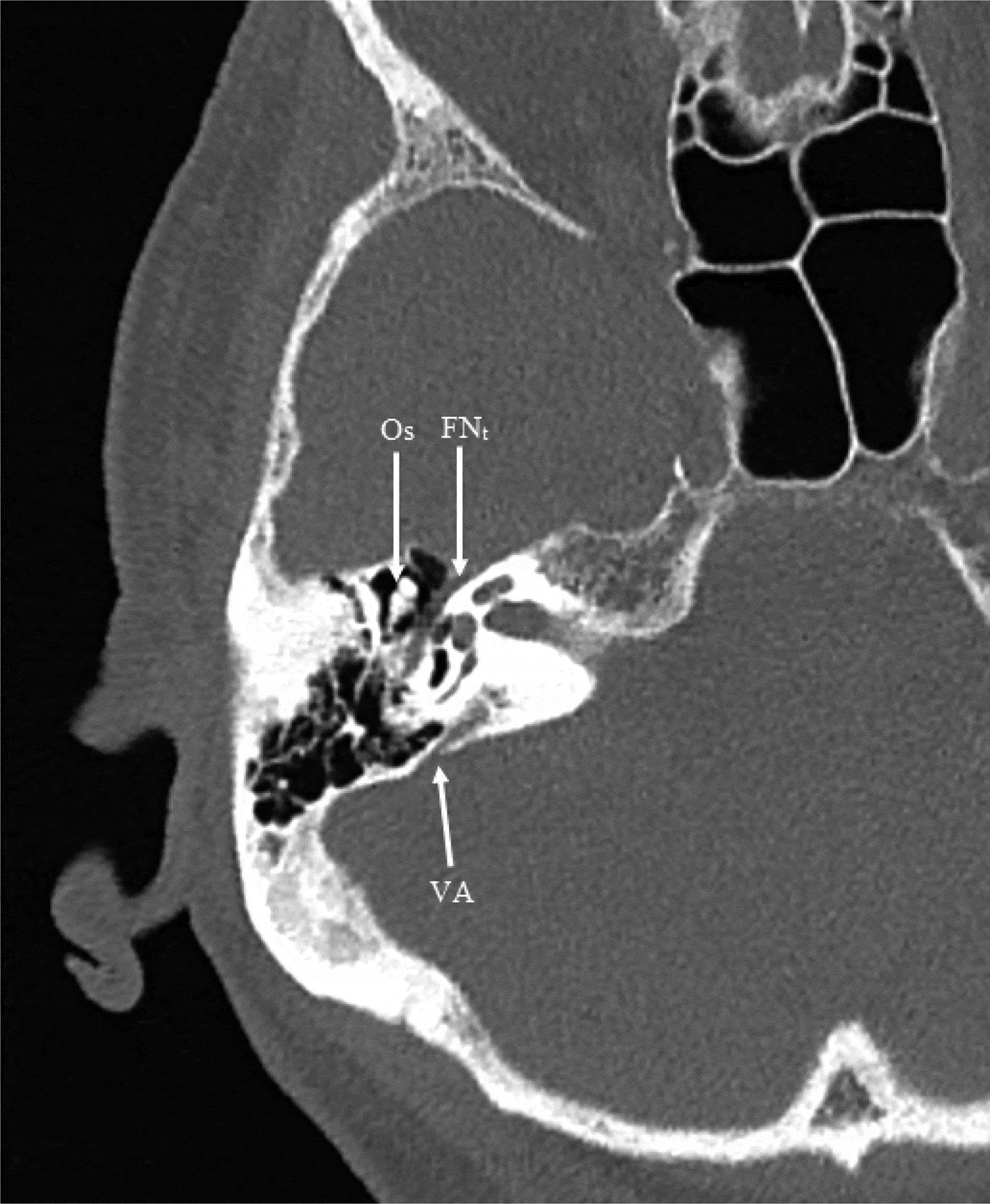 Radiology of acute mastoiditis and its complications: a pictorial ...