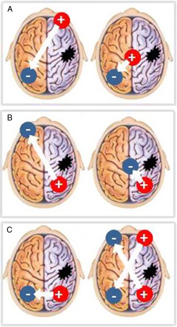 Noninvasive brain stimulation in rehabilitation of hemispatial neglect ...