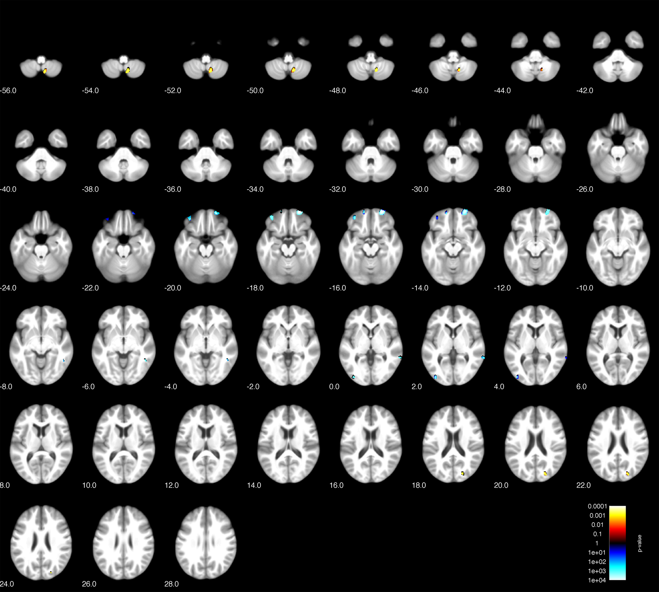 Brain structure and symptom dimensions in borderline personality ...