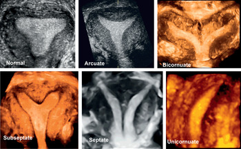 Arcuate Uterus Ultrasound