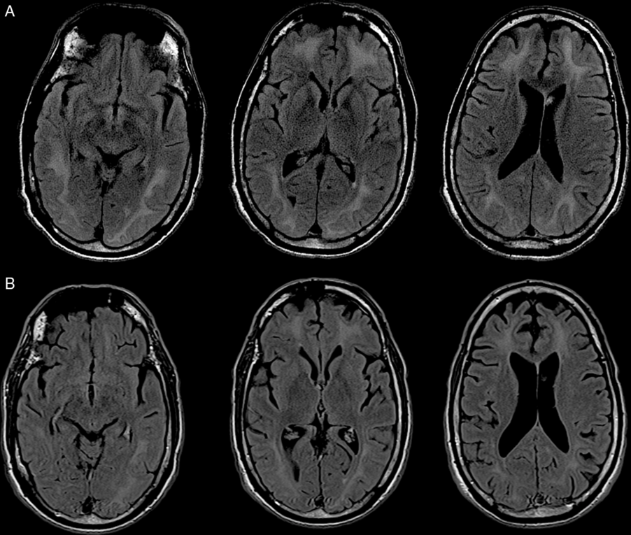 Fentanyl Overdose Causing Hippocampal Ischaemia Followed by Delayed ...