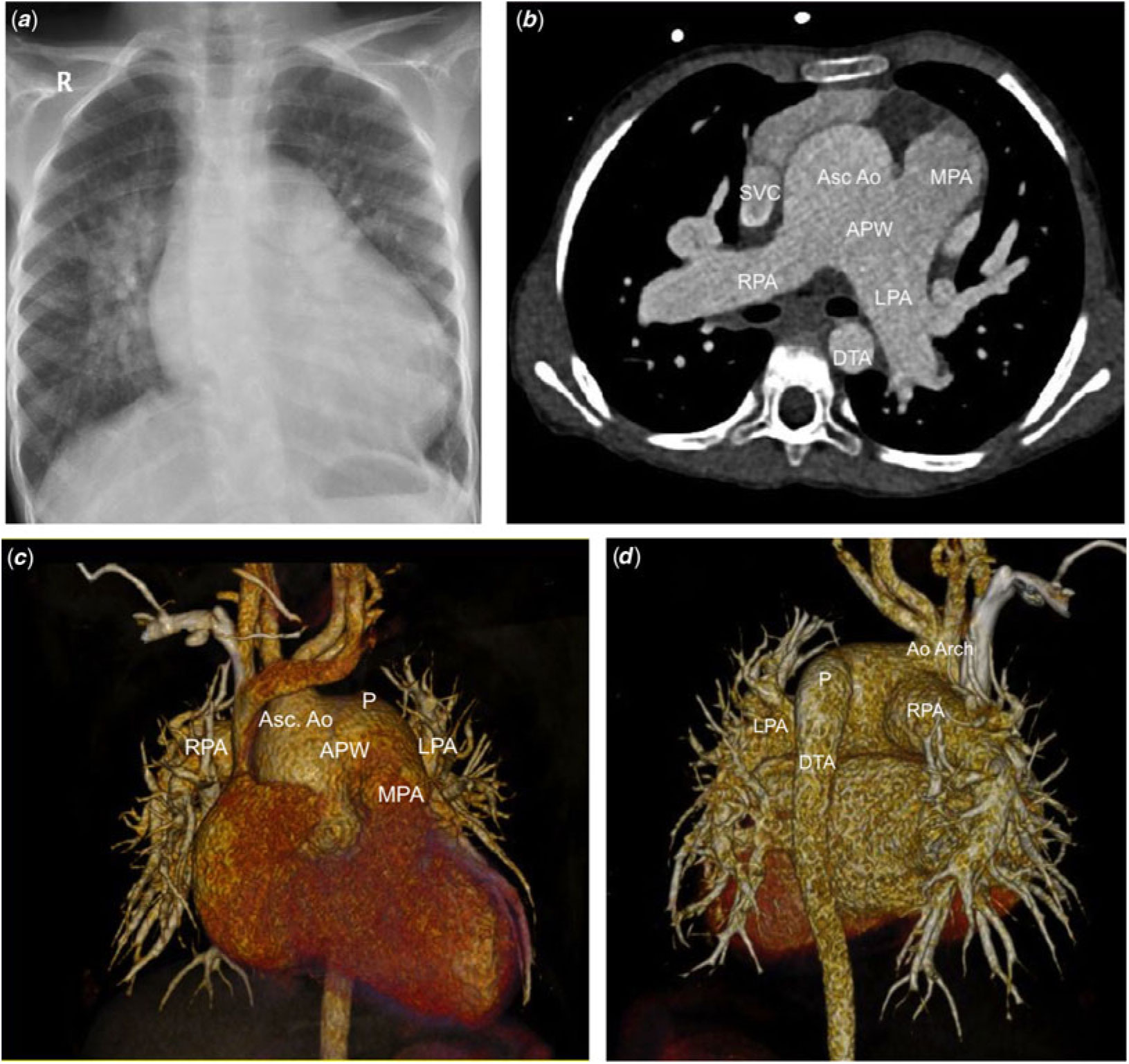 Surgical repair for aortopulmonary window with interrupted aortic arch ...