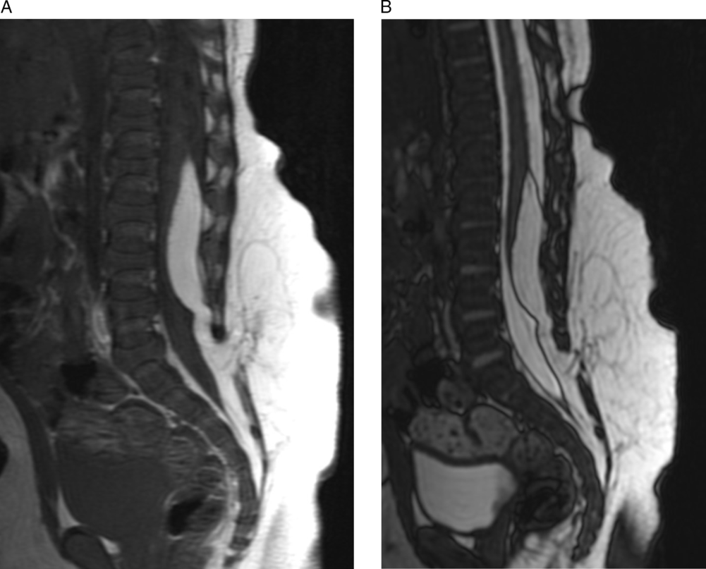 Embryology of Spinal Dysraphism and its Relationship to Surgical ...