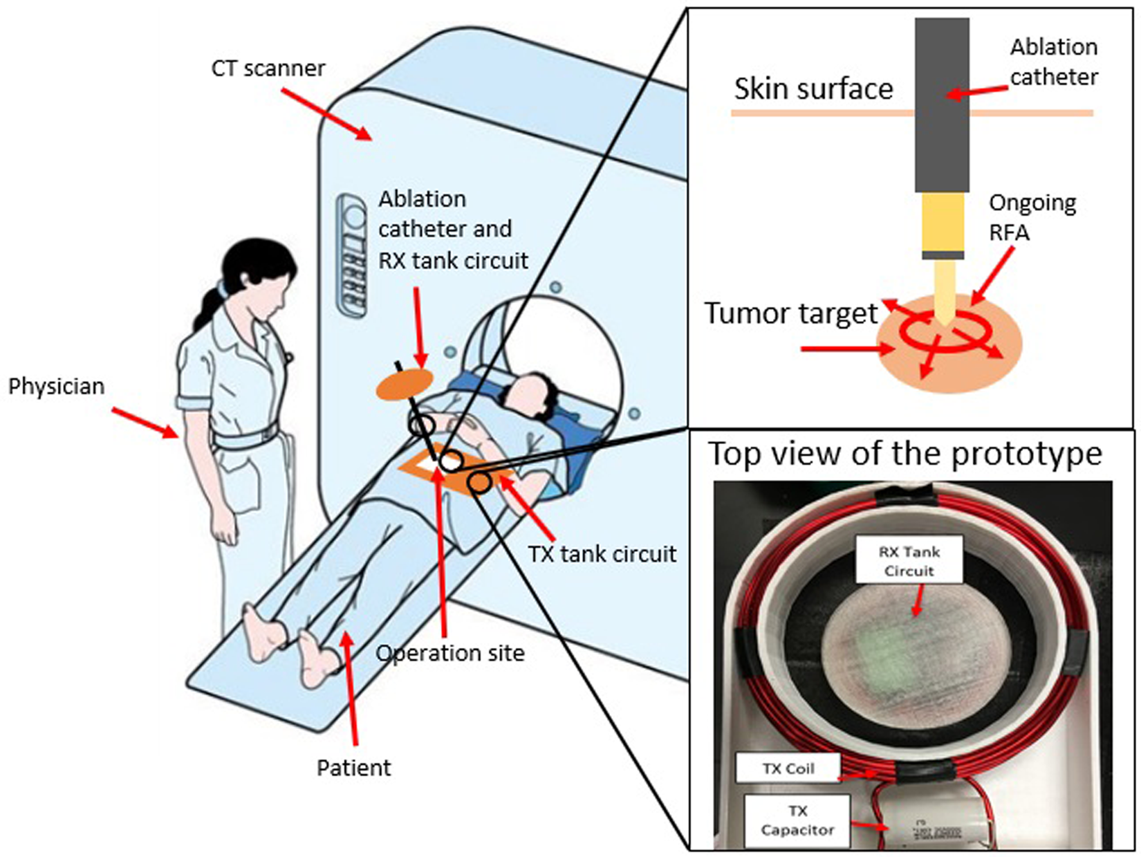 Radiofrequency tumor ablation system with a wireless or implantable ...