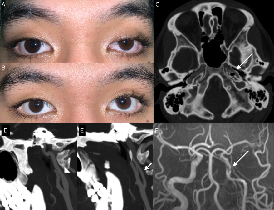 Congenital Horner’s Syndrome and Internal Carotid Artery Hypoplasia ...