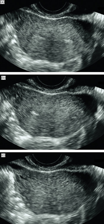 Arcuate Uterus Ultrasound