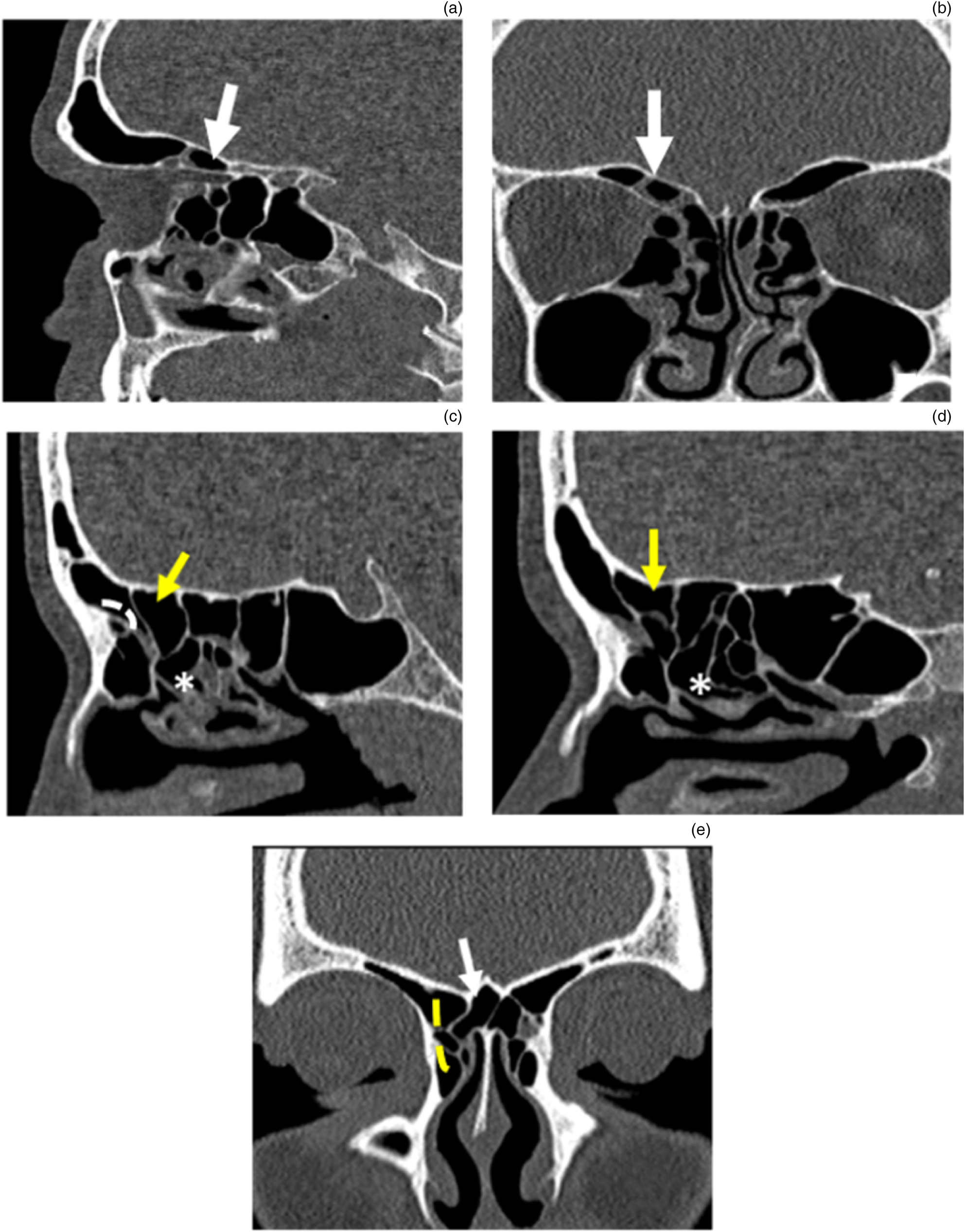 Computed tomographic analysis of the prevalence of International ...