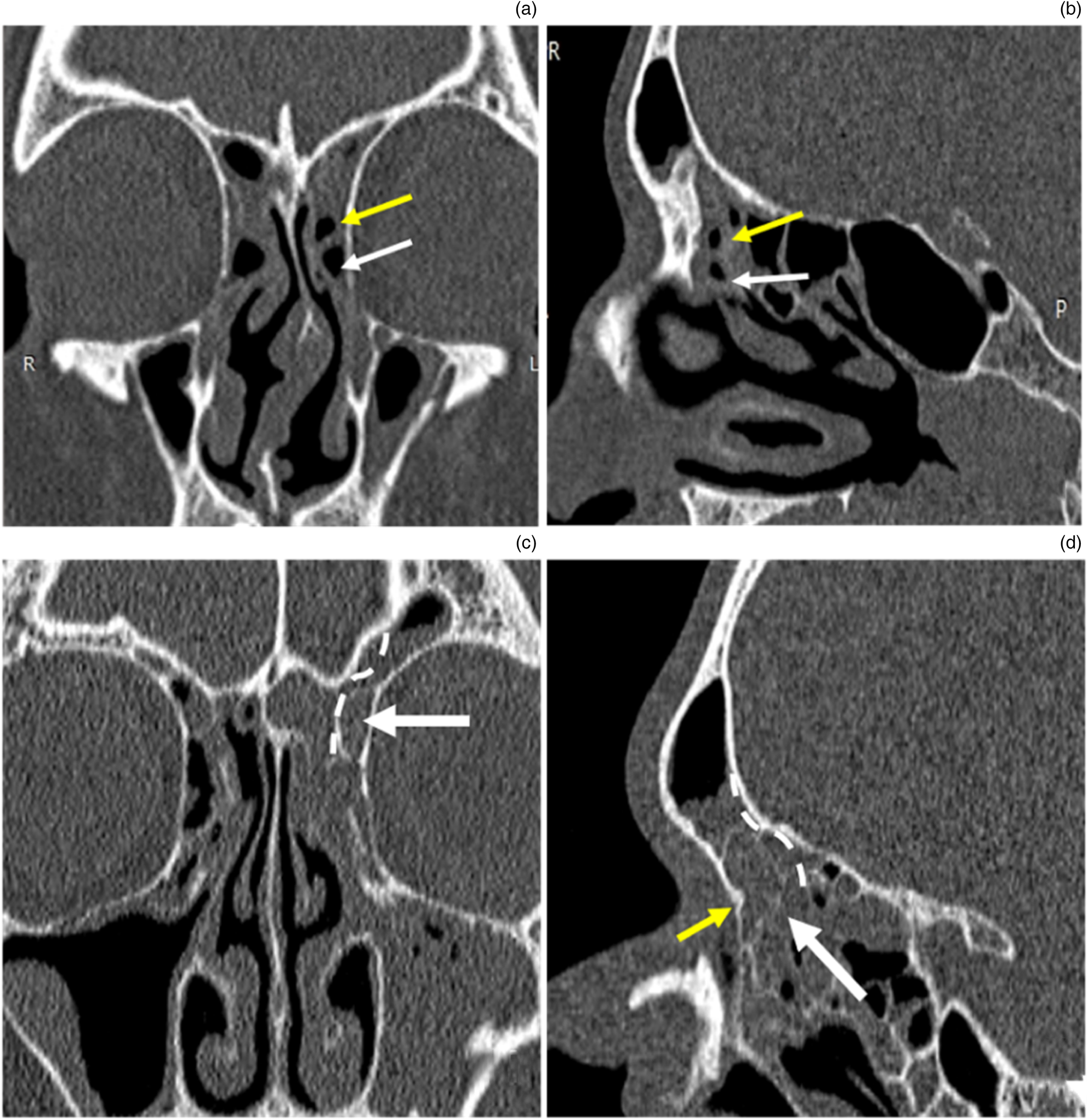 Computed tomographic analysis of the prevalence of International ...