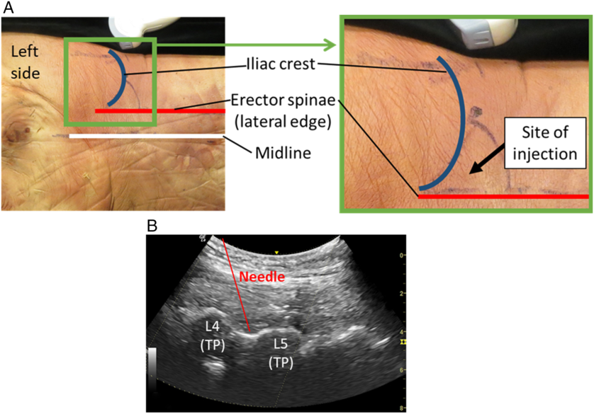 Use of the Posterior Lumbar Approach for Psoas Major Injection in Hip ...