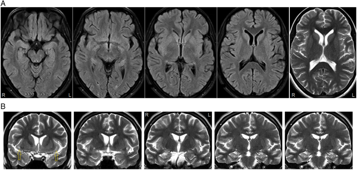 Possible Autoimmune Encephalitis with Claustrum Sign in case of Acute ...