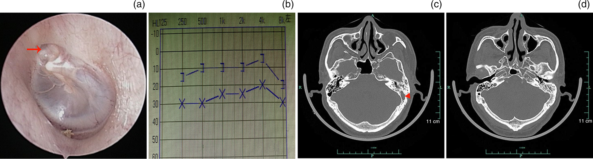 Middle-ear or mastoid granulation pathology associated with retraction ...