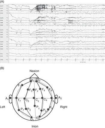 Montages (Chapter 3) - How to Read an EEG