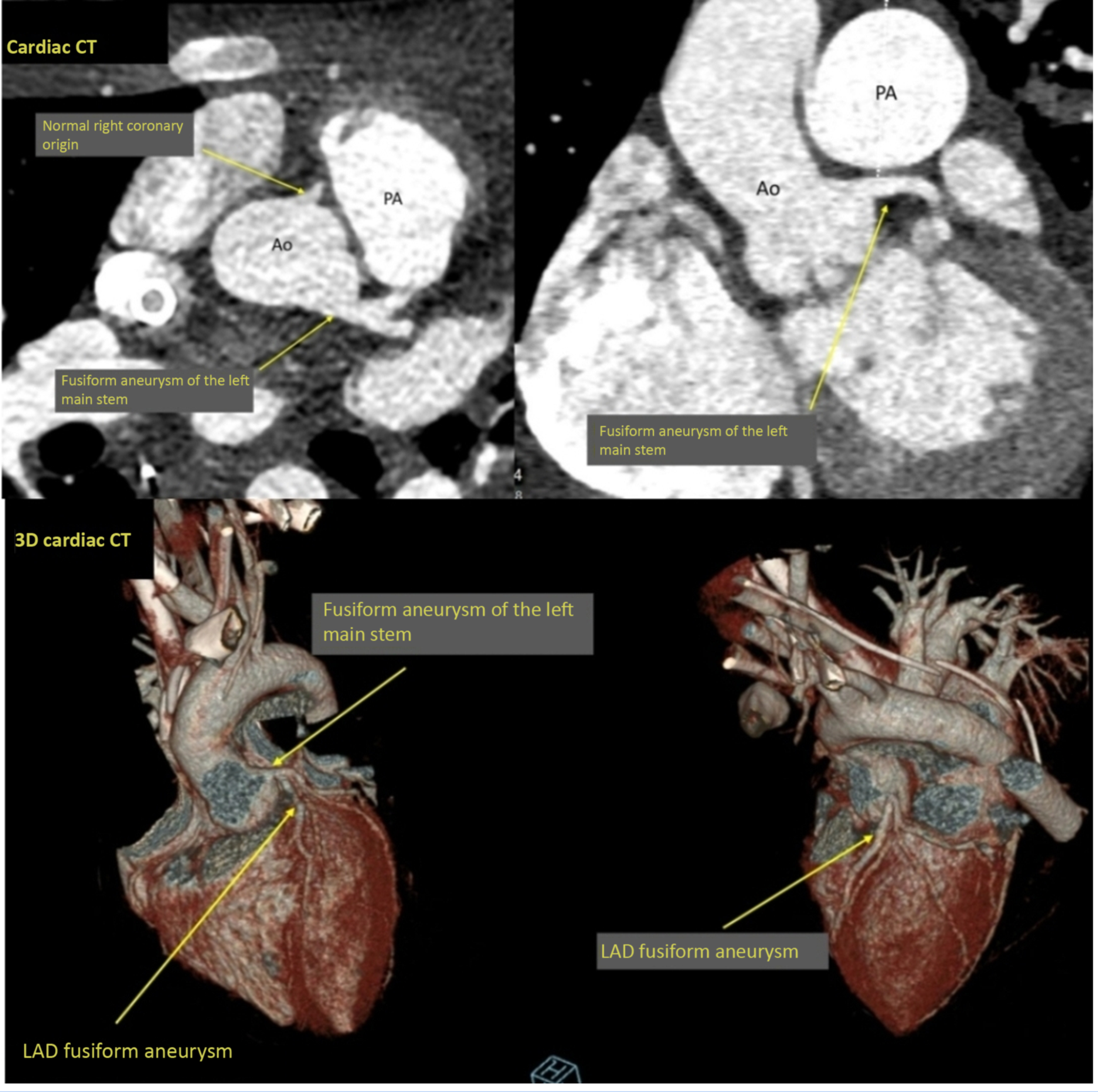 Coronary aneurysms, myocardial dysfunction, and shock in a COVID-19 child, role of ECMO ...