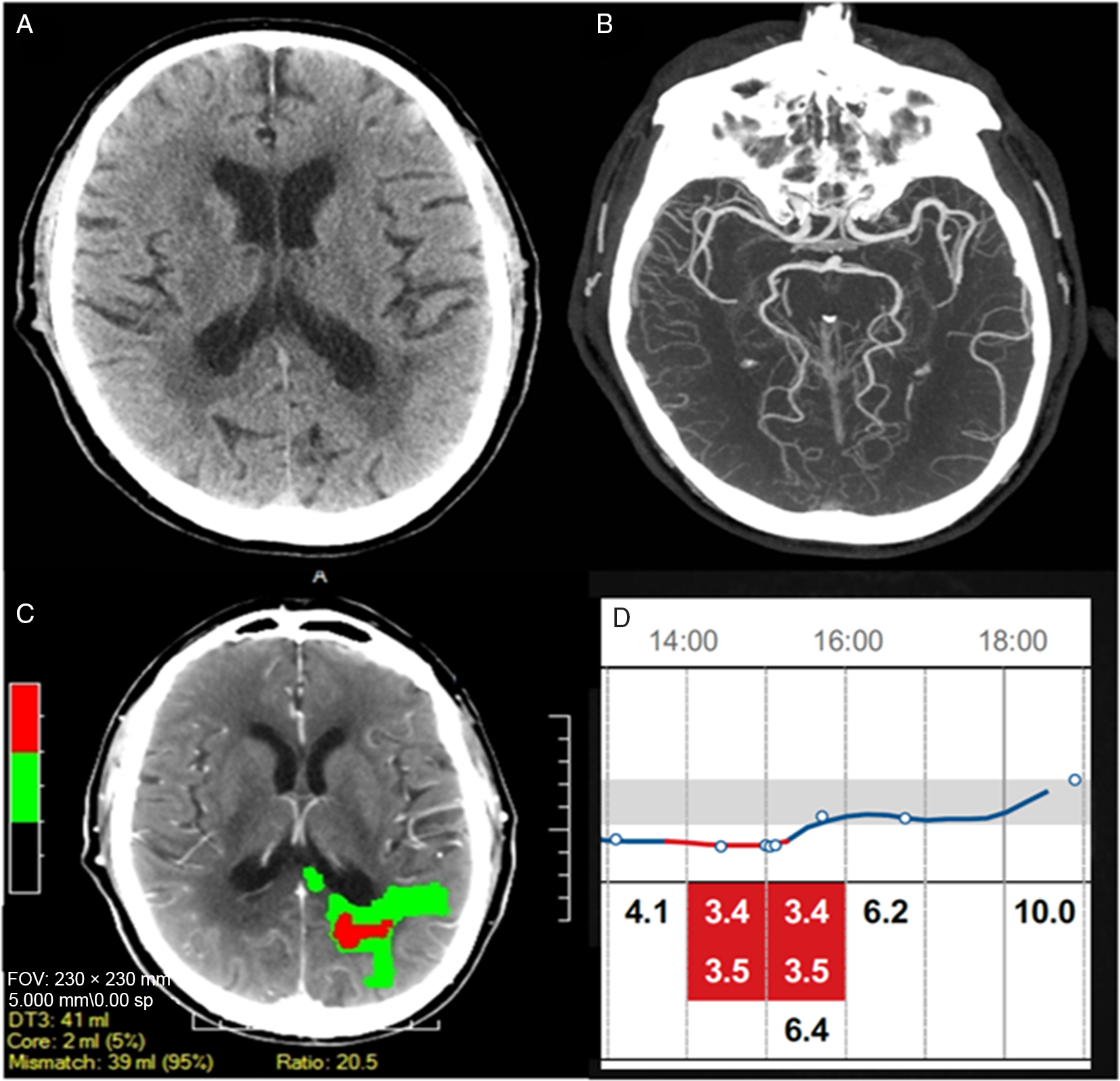 Hypoglycemia Causing Focal Cerebral Hypoperfusion and Acute Stroke ...