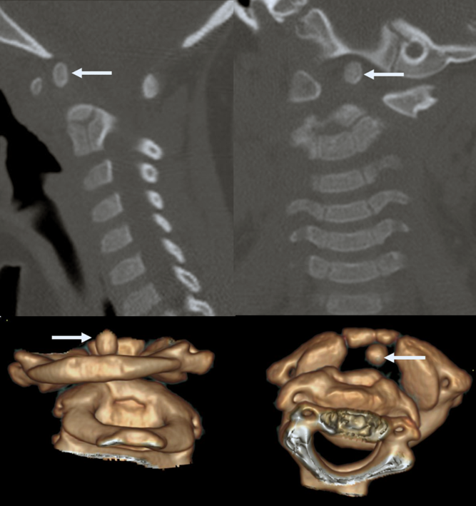 Imaging Findings in an Early Symptomatic Dystopic Os Odontoideum ...