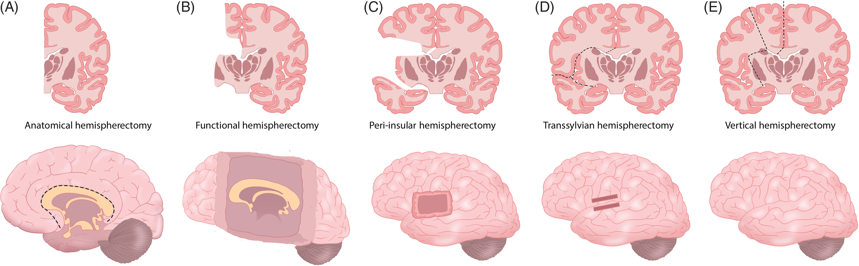 Hemispherotomy for Epilepsy: The Procedure Evolution and Outcome ...