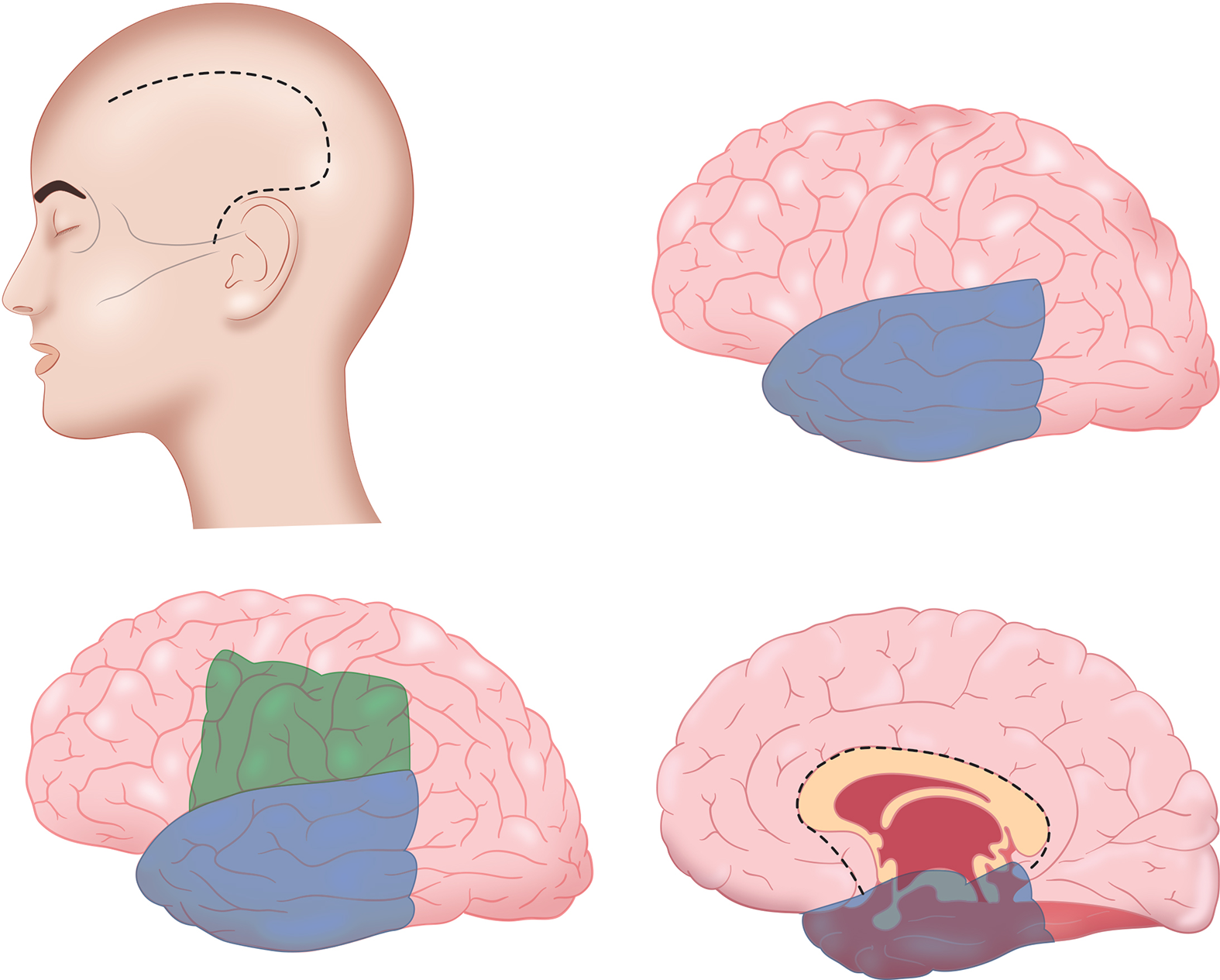 Hemispherotomy for Epilepsy: The Procedure Evolution and Outcome ...