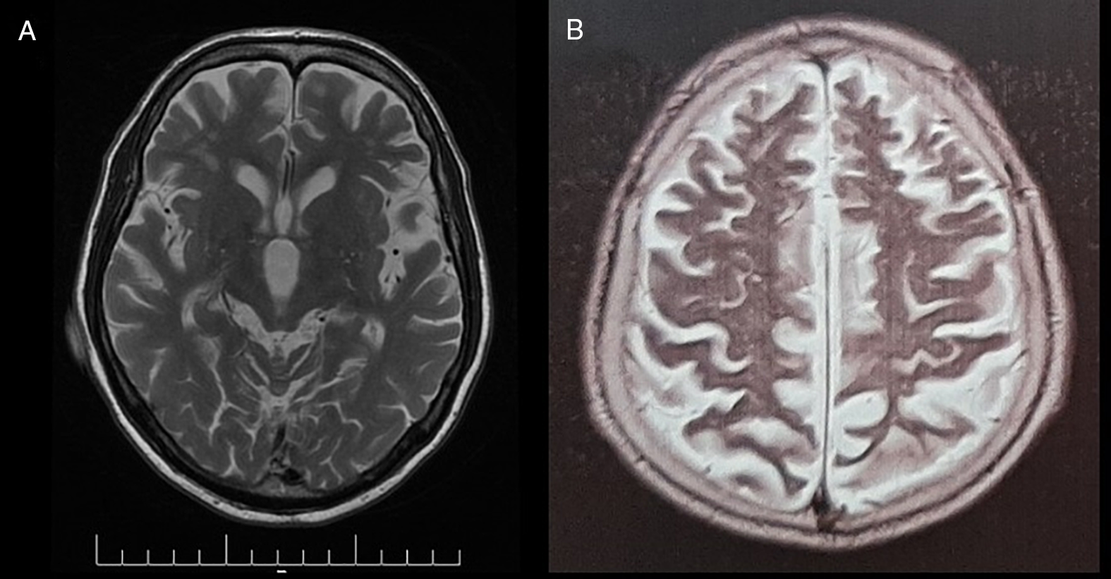Alien Leg Syndrome in Two Cases of Corticobasal Syndrome | Canadian ...