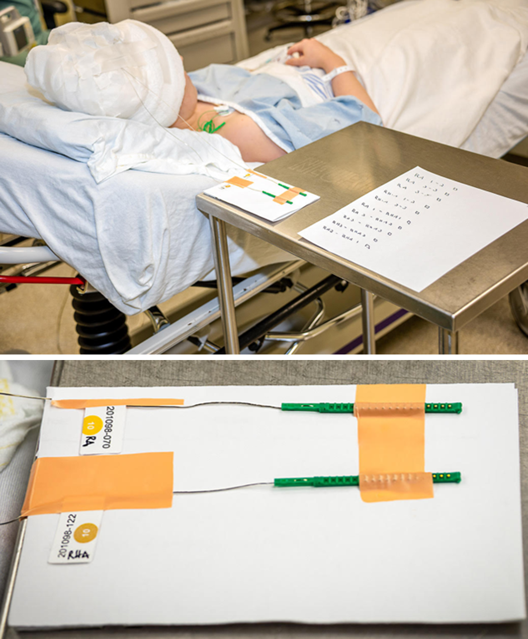 Radiofrequency Thermocoagulation in Refractory Focal Epilepsy: The ...