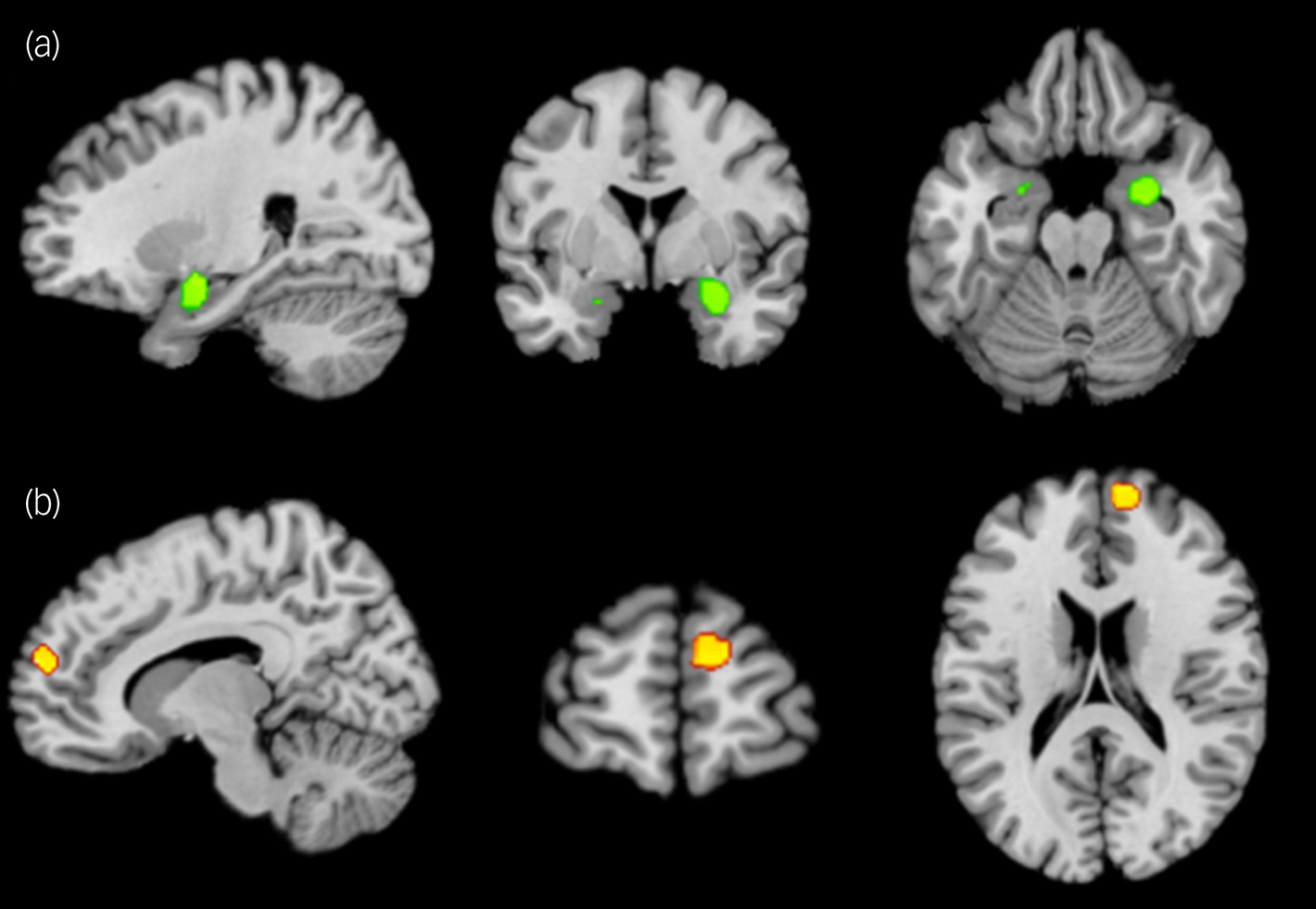 Neural effects of antidepressant medication and psychological ...