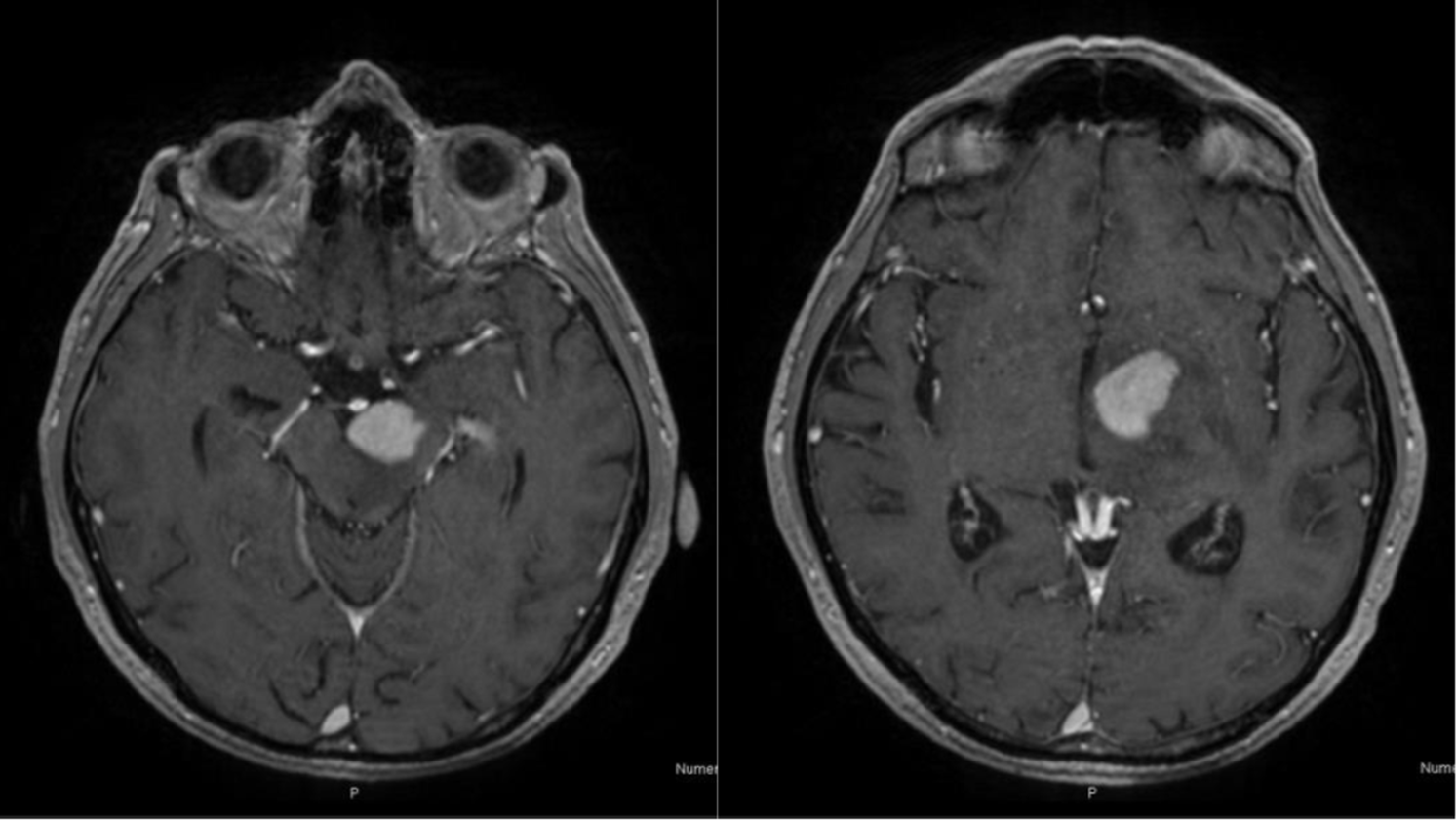 Richter’s Syndrome of the Central Nervous System | Canadian Journal of ...