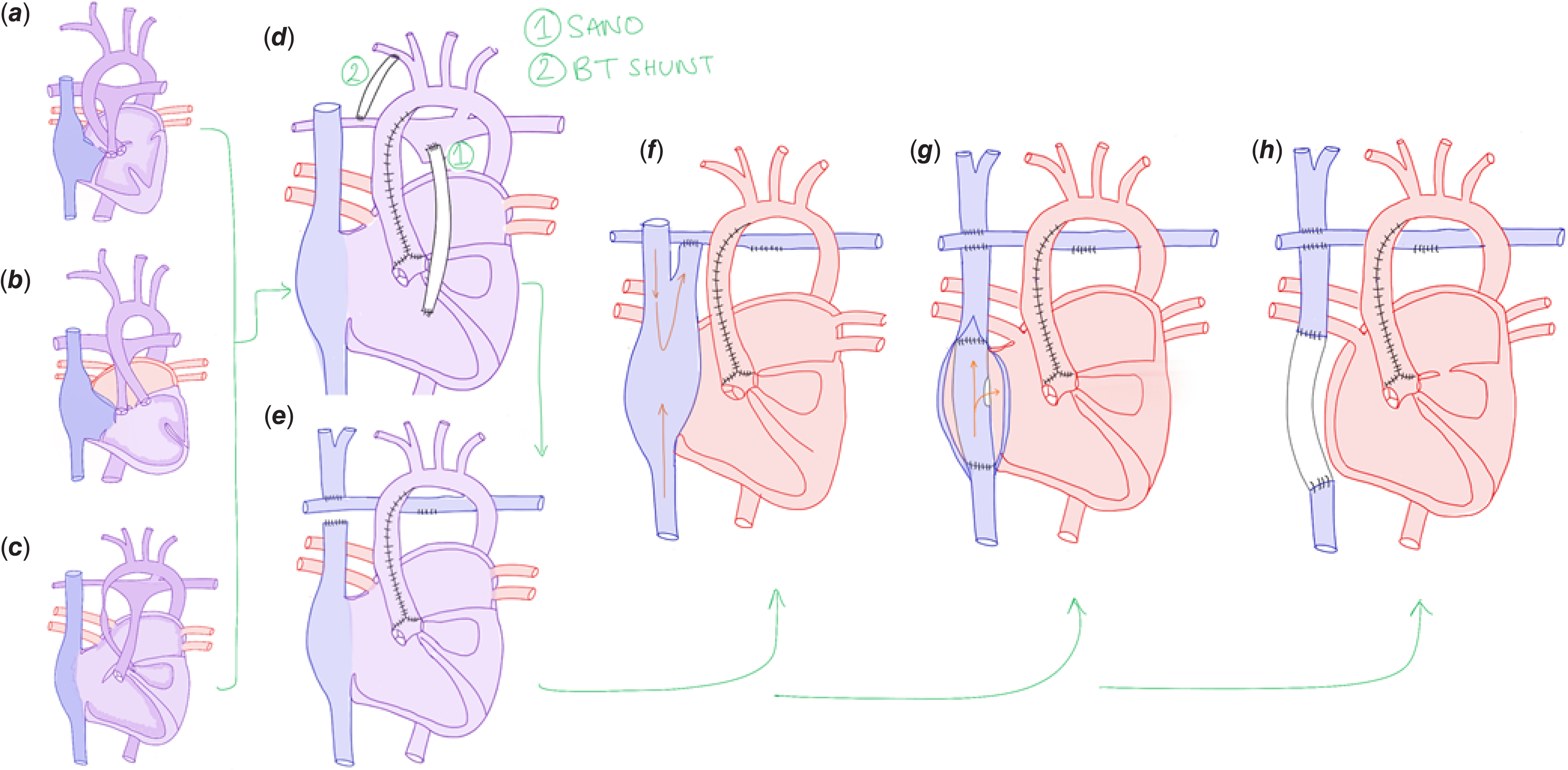 Perioperative and long-term management of Fontan patients | Cardiology ...