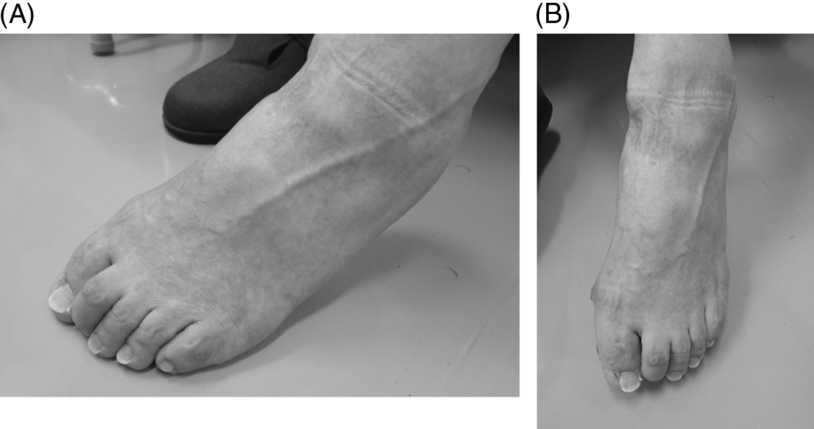 Claw Toe: Anatomic Guide for Injection of Botulinum Toxin into Foot ...