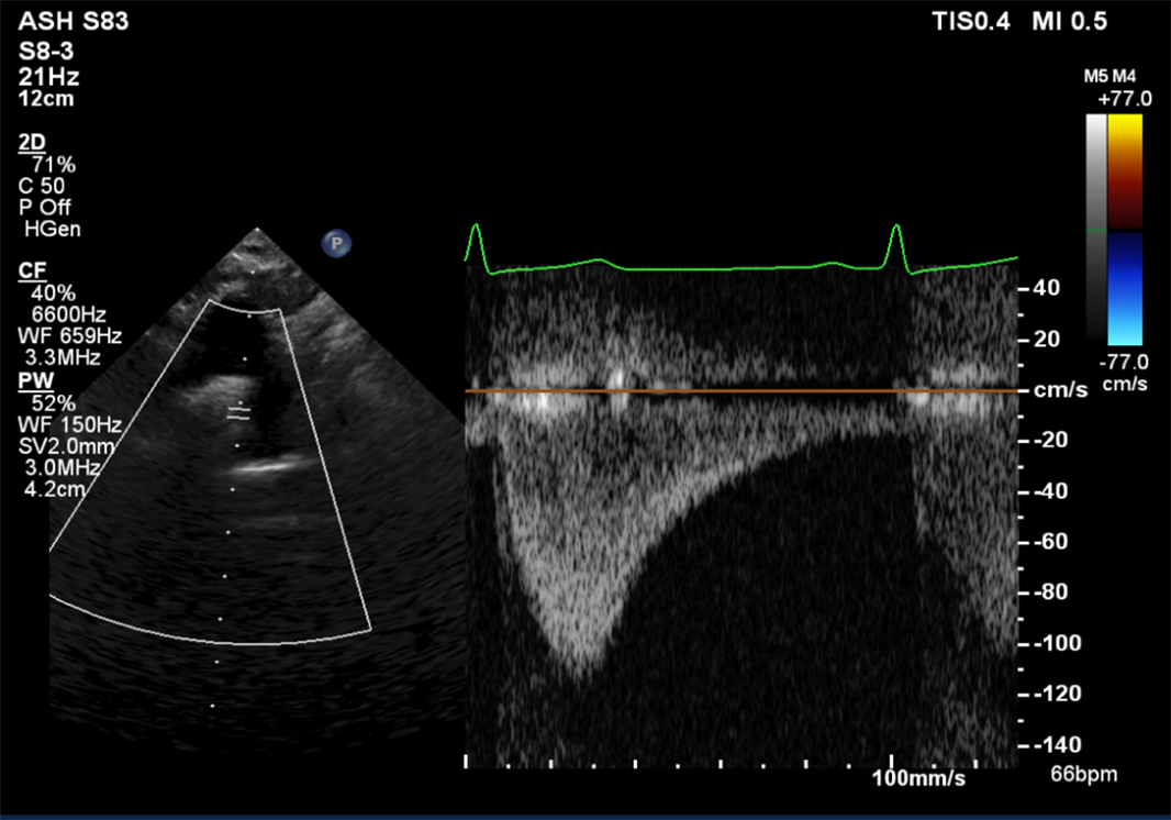 Severe coarctation of the aorta without a severely elevated ...