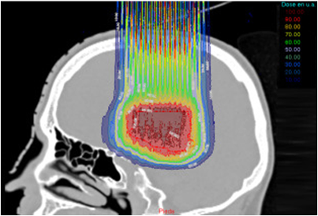 Divide and conquer: spatially fractionated radiation therapy | Expert ...