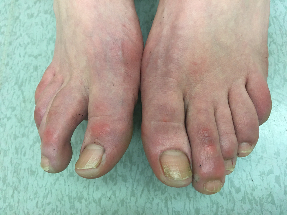 Chilblain-like lesions likely associated with coronavirus disease 2019 ...