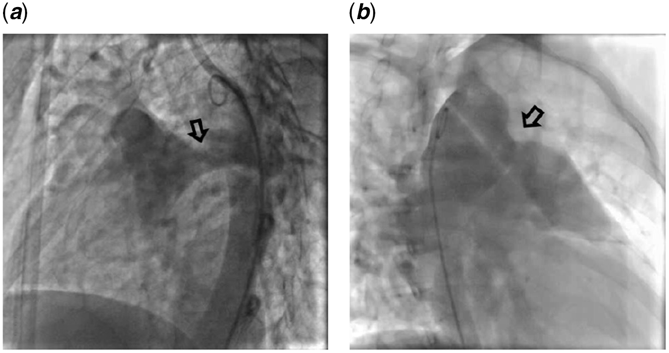 Trans-catheter closure of large PDA in adult patients with Amplatzer ...